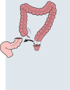 The Clinical Benefits of SafeHeal Products for Anastomosis Protection